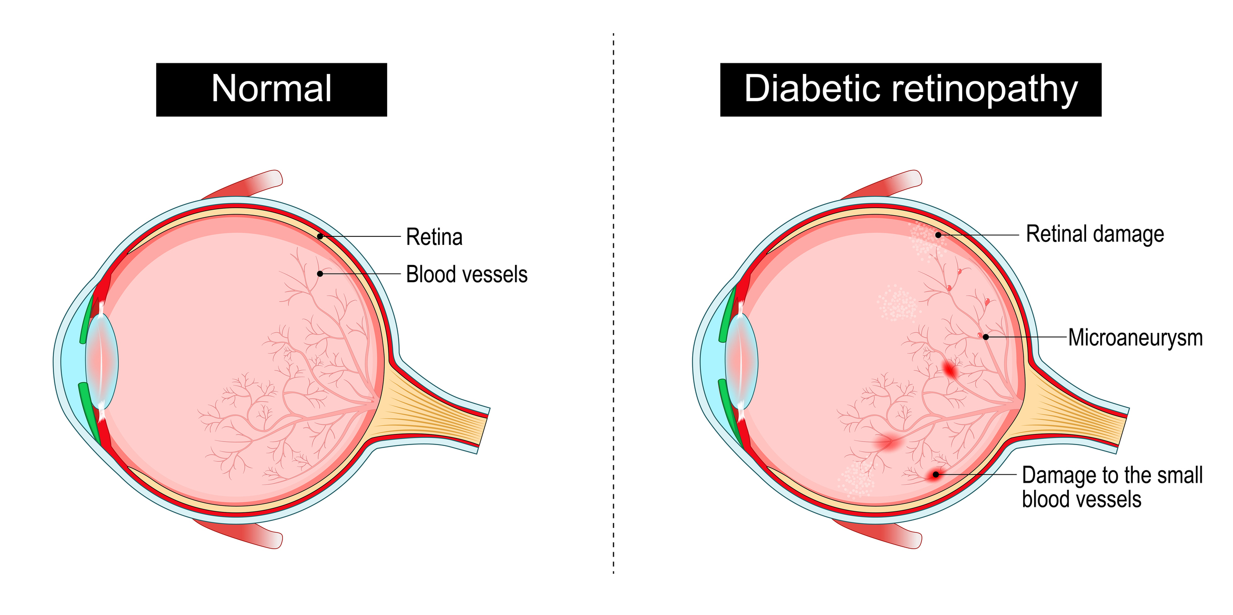 Proving Vision Impairment from Diabetic Retinopathy for Social Security ...
